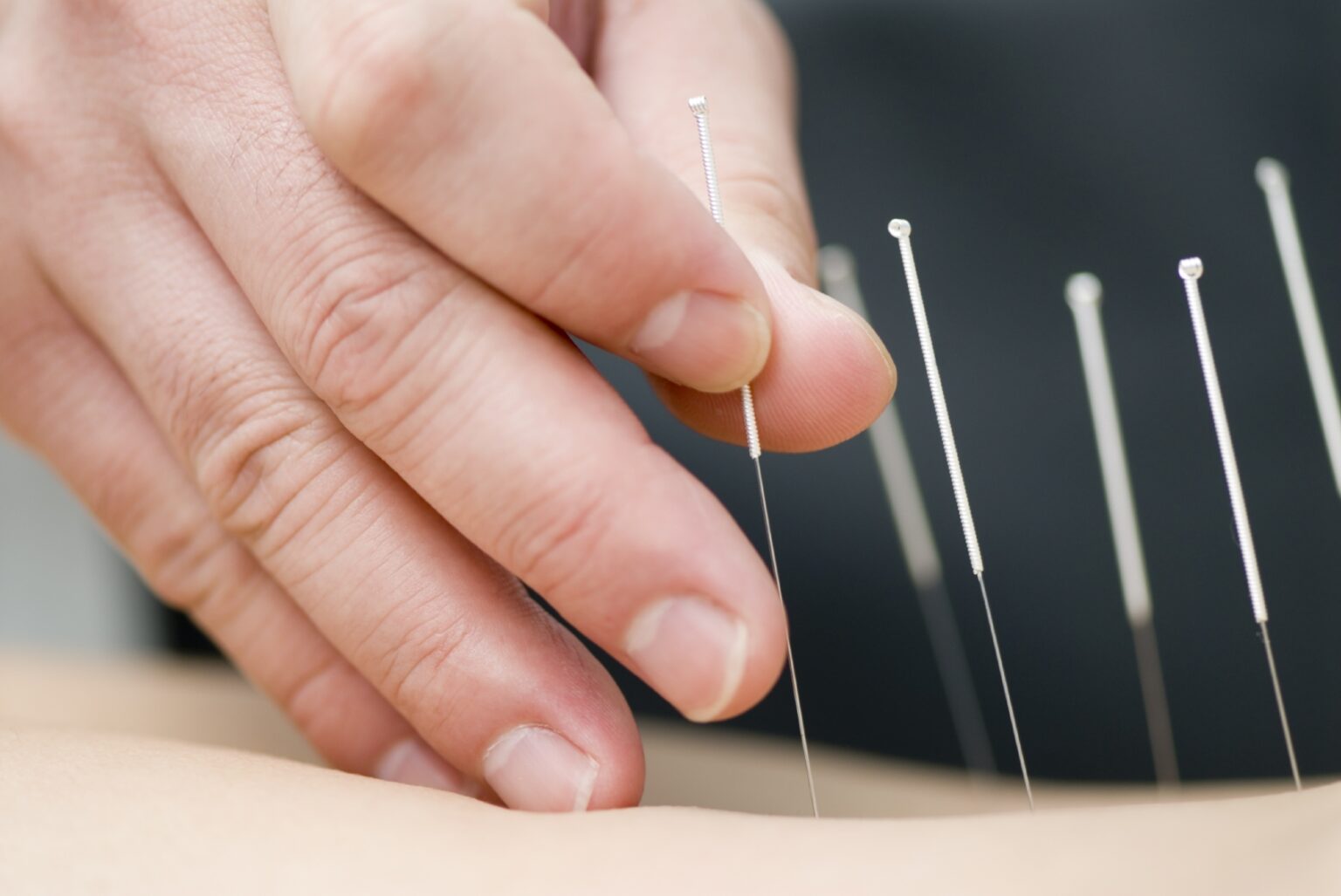 Punción seca cervical y del cuello | eFISIO Fisioterapia Madrid