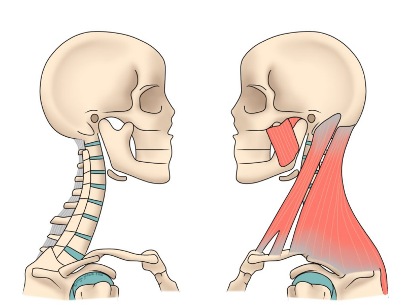 Esguince Cervical: Tratamiento con Fisioterapia | eFISIO Fisioterapia ...